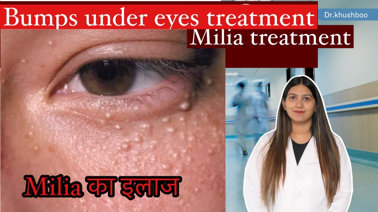 Tiny Bumps On Face Milia Treatment tiny-bumps-on-face-milia-treatment
