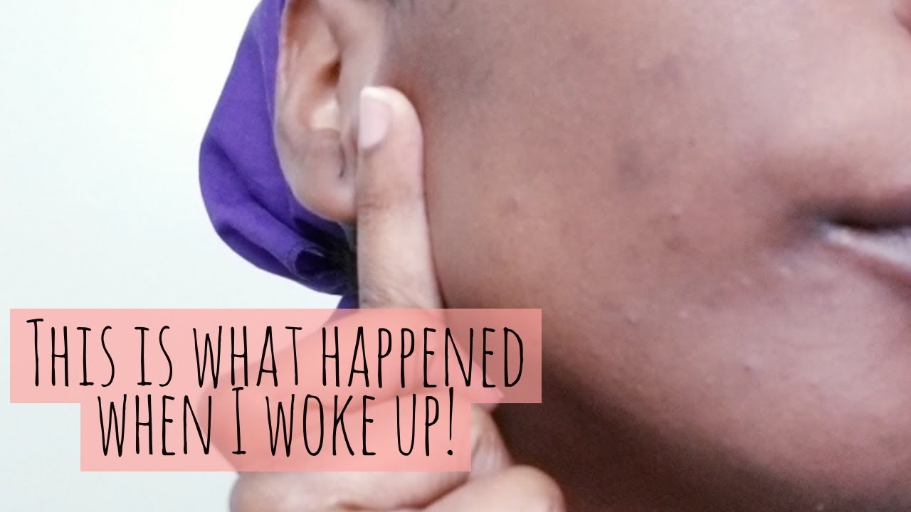 SKIN CARE- PART 1 | ACNE BREAK-OUT | Beauty Chronicles - YouTube