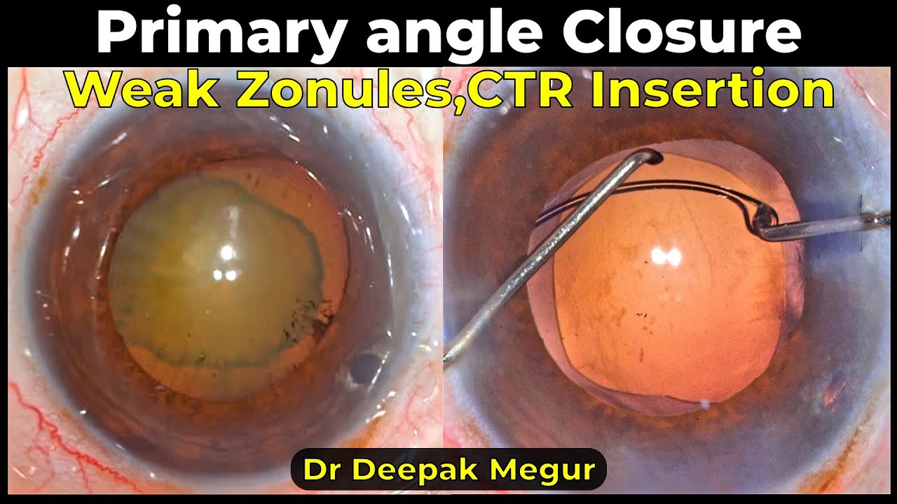 Phacoemulsification In eye with weak Zonules,Primary angle Closure ...