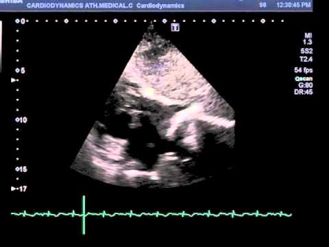 Right Atrial Mass - YouTube