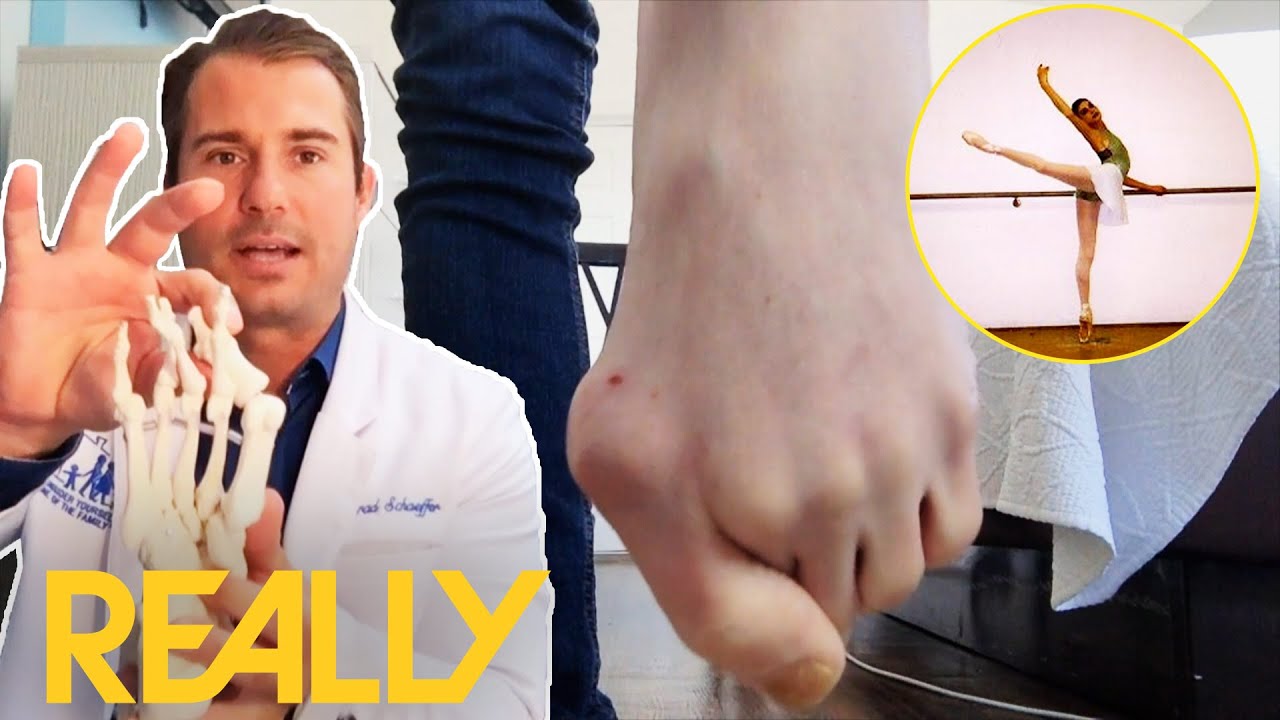 Doctor Treats Worst Case Of Dancer’s Feet He’s Ever Seen | My Feet Are ...