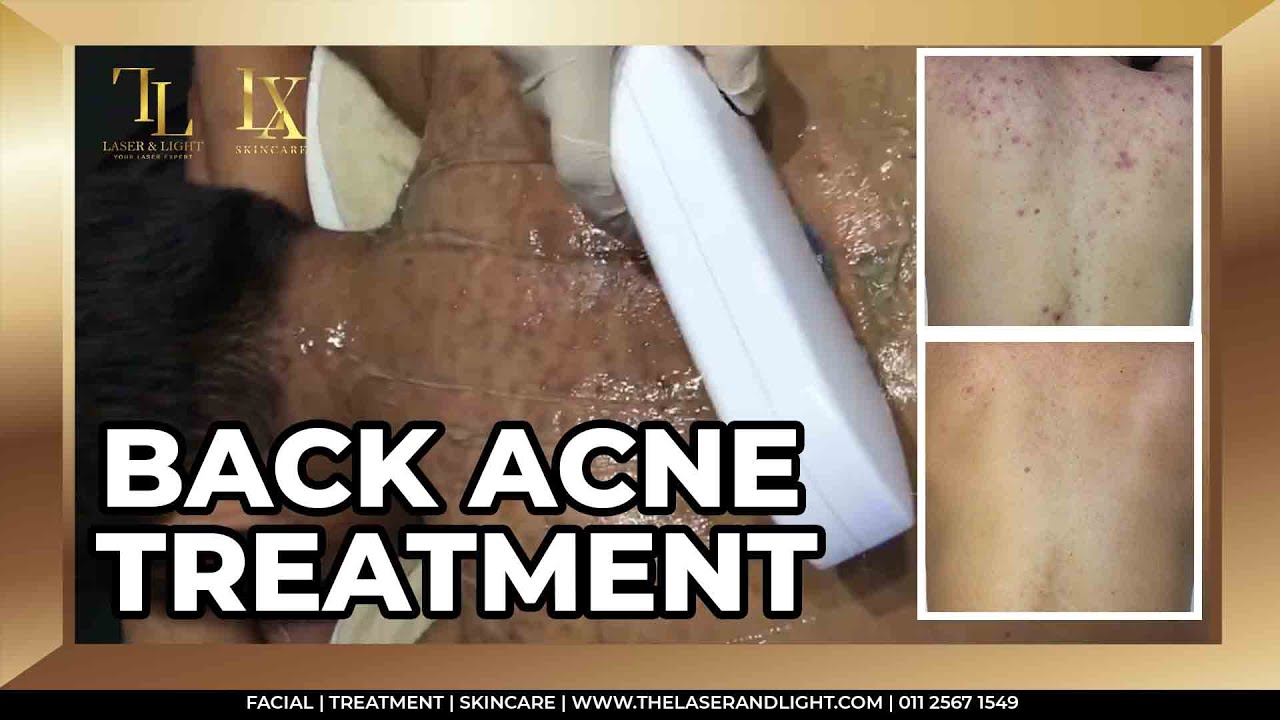 Back Acne Treatment⚡️Get Rid Bacne Using Medical-Grade devices. - YouTube