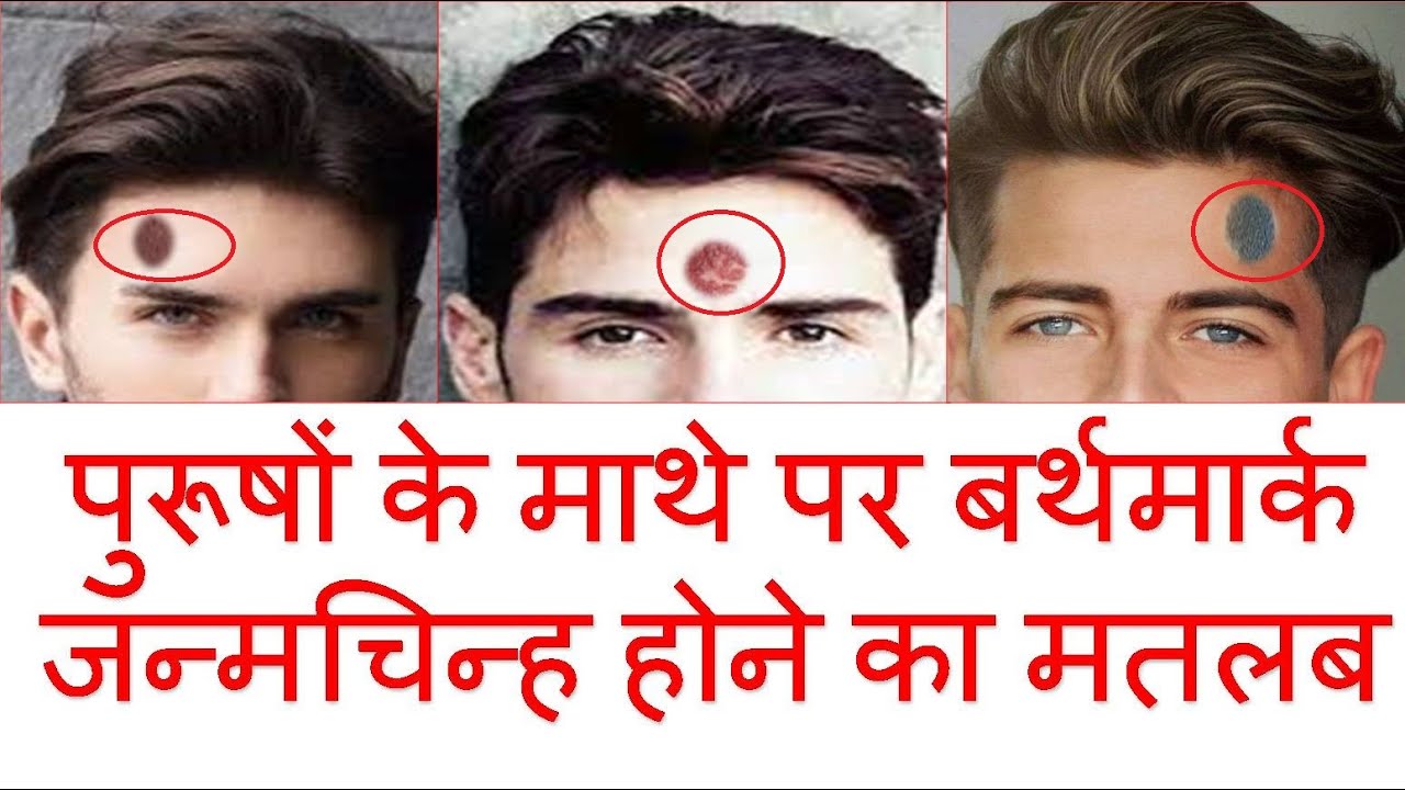 पुरुषो के माथे पर बर्थमार्क जन्मचिन्ह होने का मतलब| Birthmark on ...