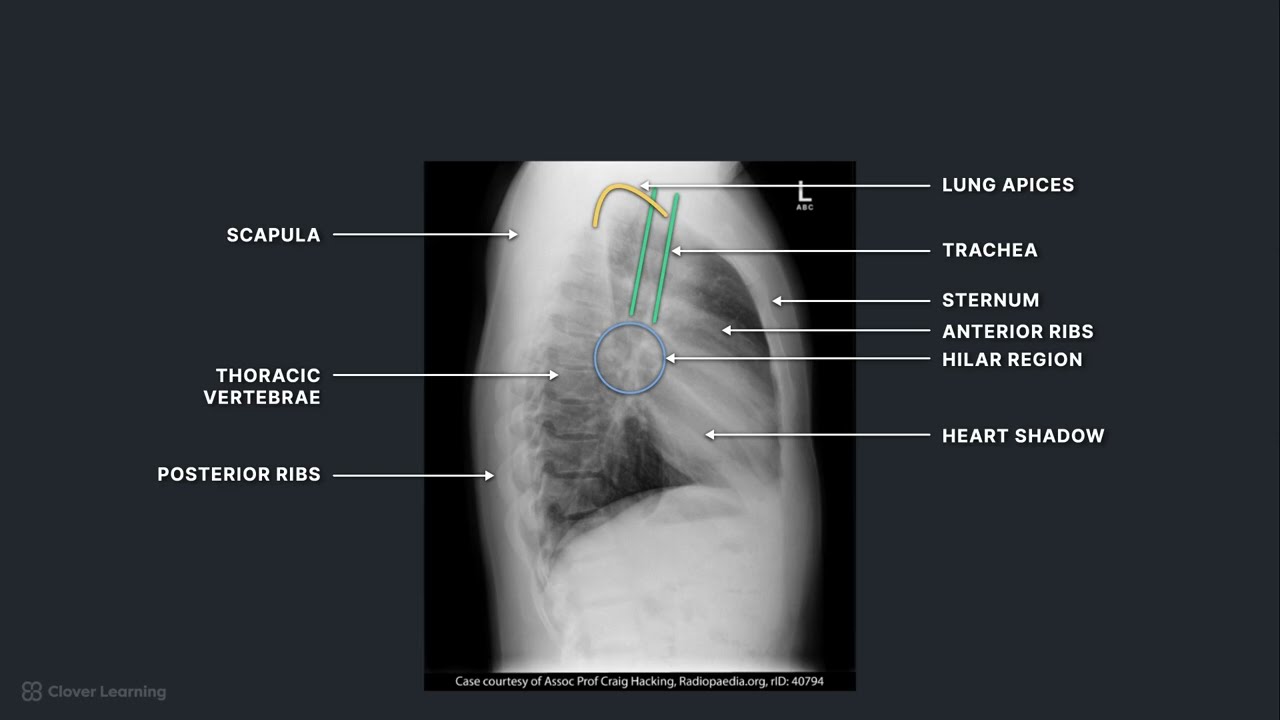 X Ray Chest Anatomy