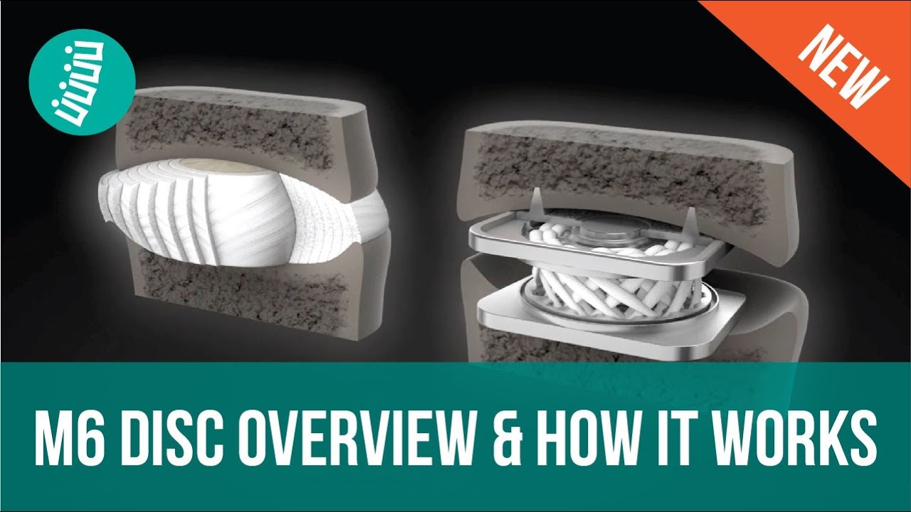 M6 Artificial Disc Replacement (ADR) by Spinal Kinetics - YouTube