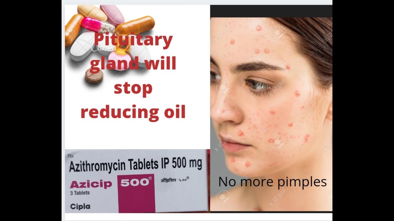 Azithromycin tablets use for pimples - YouTube