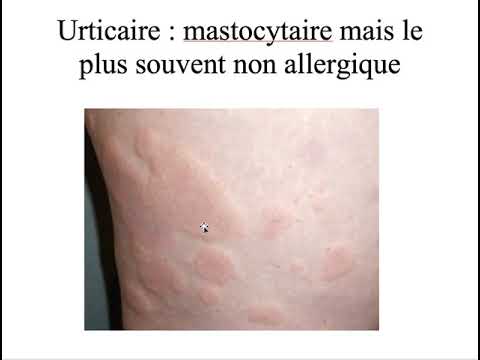 Allergies 1ère partie - YouTube