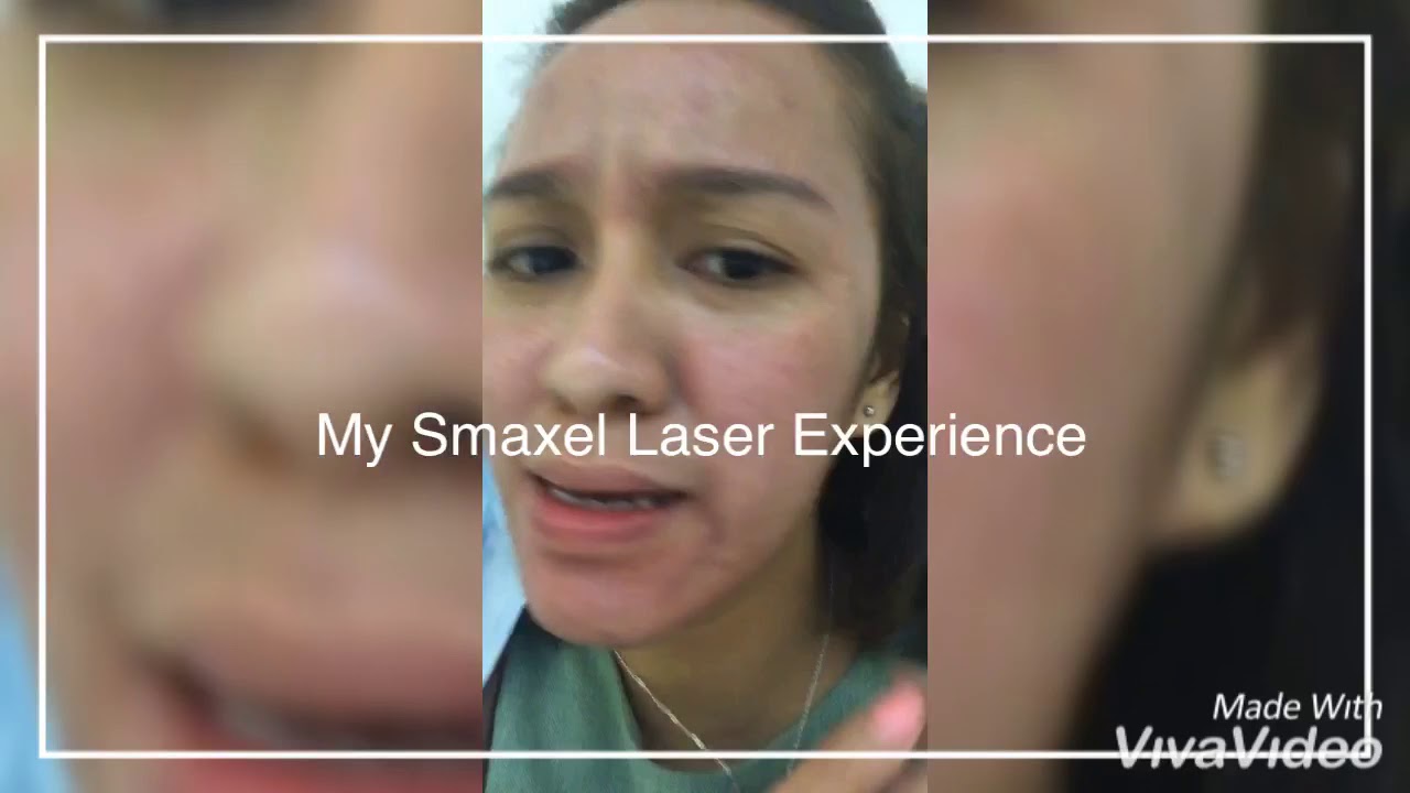 My Smaxel Laser Experience - YouTube