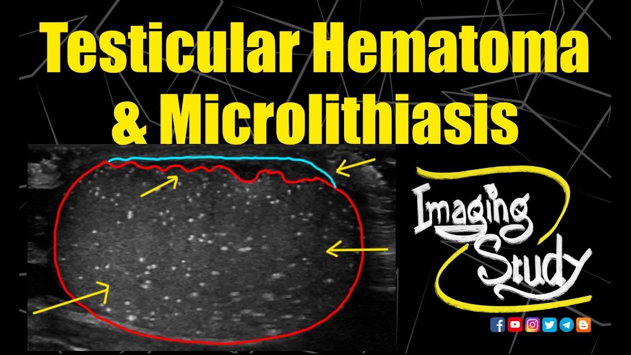Intratesticular Hematoma A Sagittal Gray Scale Us Ima