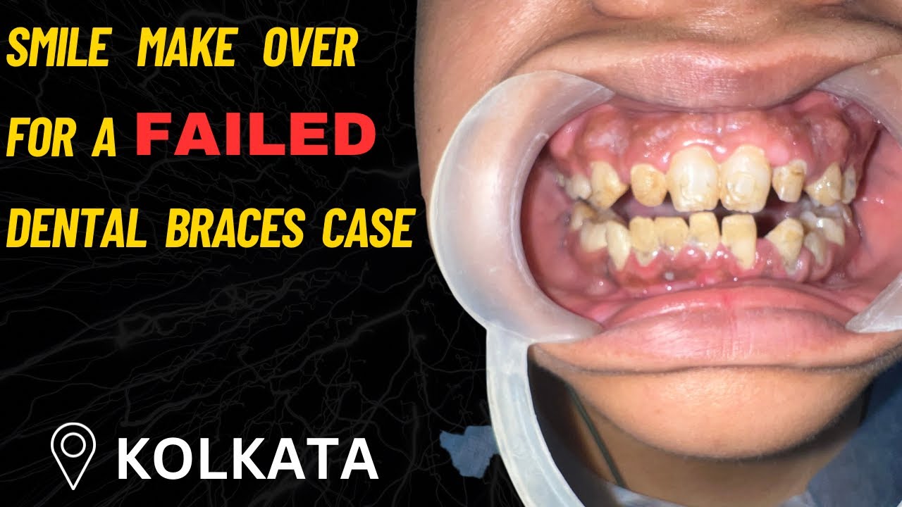 Correction of Failed Dental Braces Case in Kolkata | Best Cosmetic ...