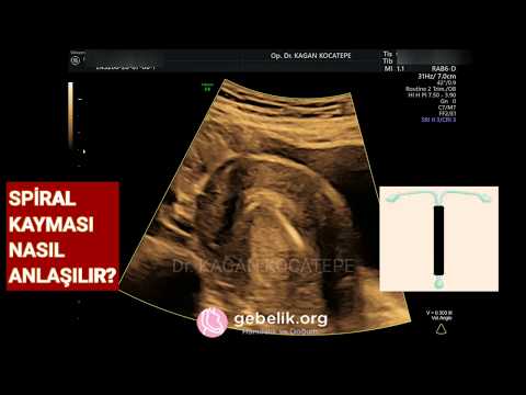 SPİRAL ULTRASONDA RAHİMDE NASIL GÖRÜNÜR, SPİRALİN YERİNDEN KAYDIĞI NASIL ANLAŞILIR,BELİRTİ VERİR Mİ?