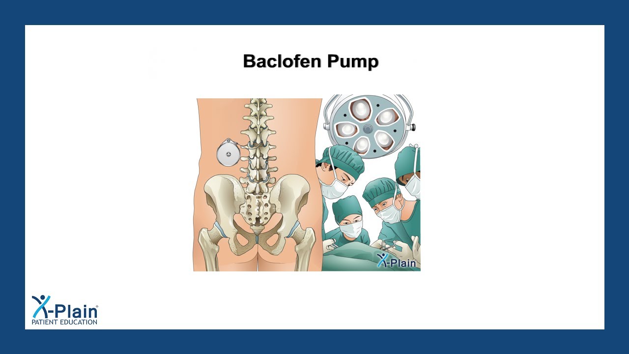 Baclofen Pump - YouTube