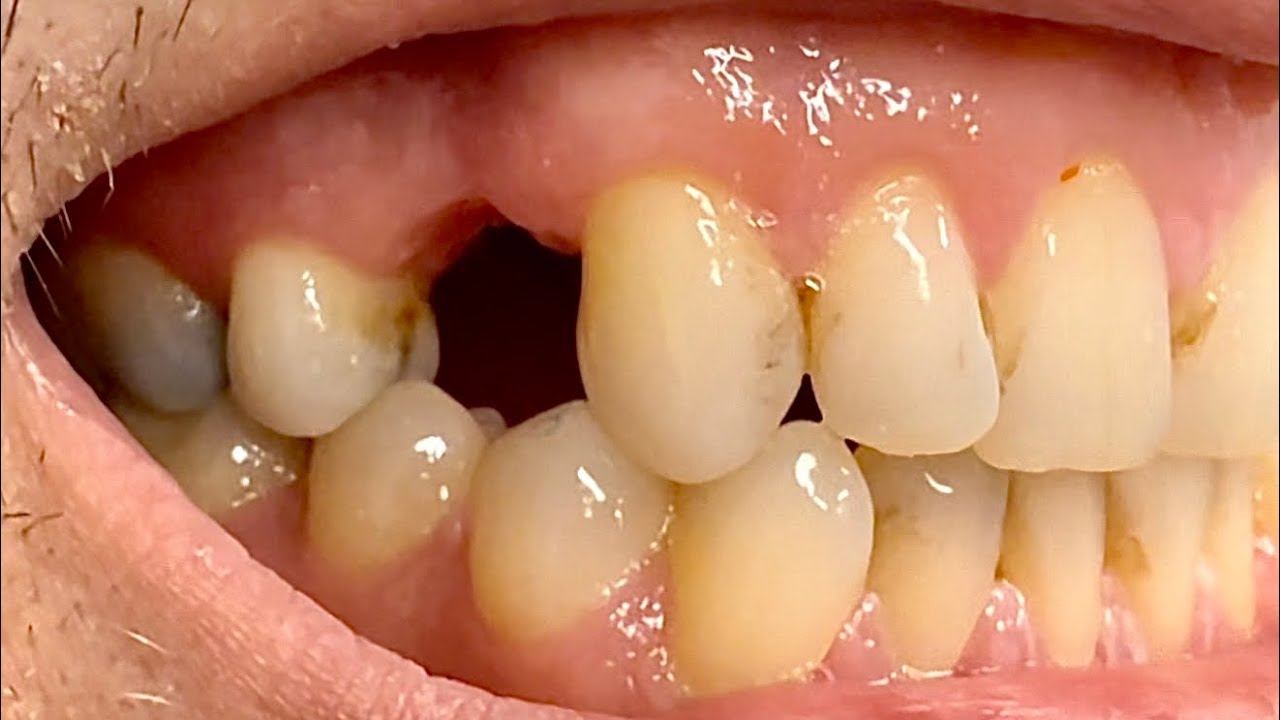 Flipper - Quick Temporary Replacement of a Missing Tooth! @GreatTeeth ...