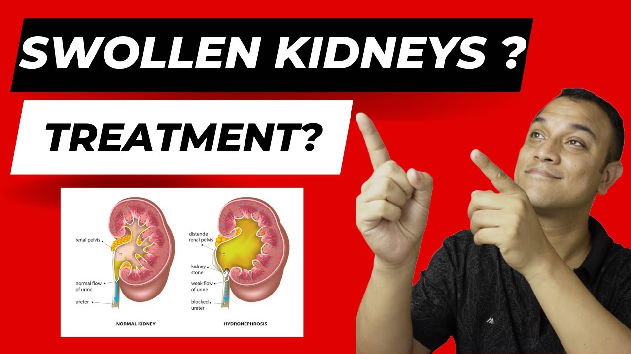 Are your kidneys swollen? Hydronephrosis - Dr. Diwakar Manandhar - YouTube