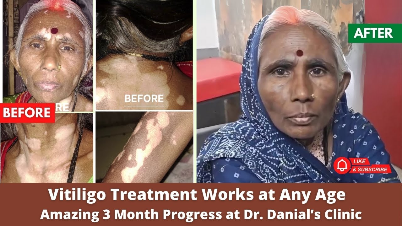 Vitiligo Treatment Works at Any Age | Amazing 3 Month Progress at Dr ...