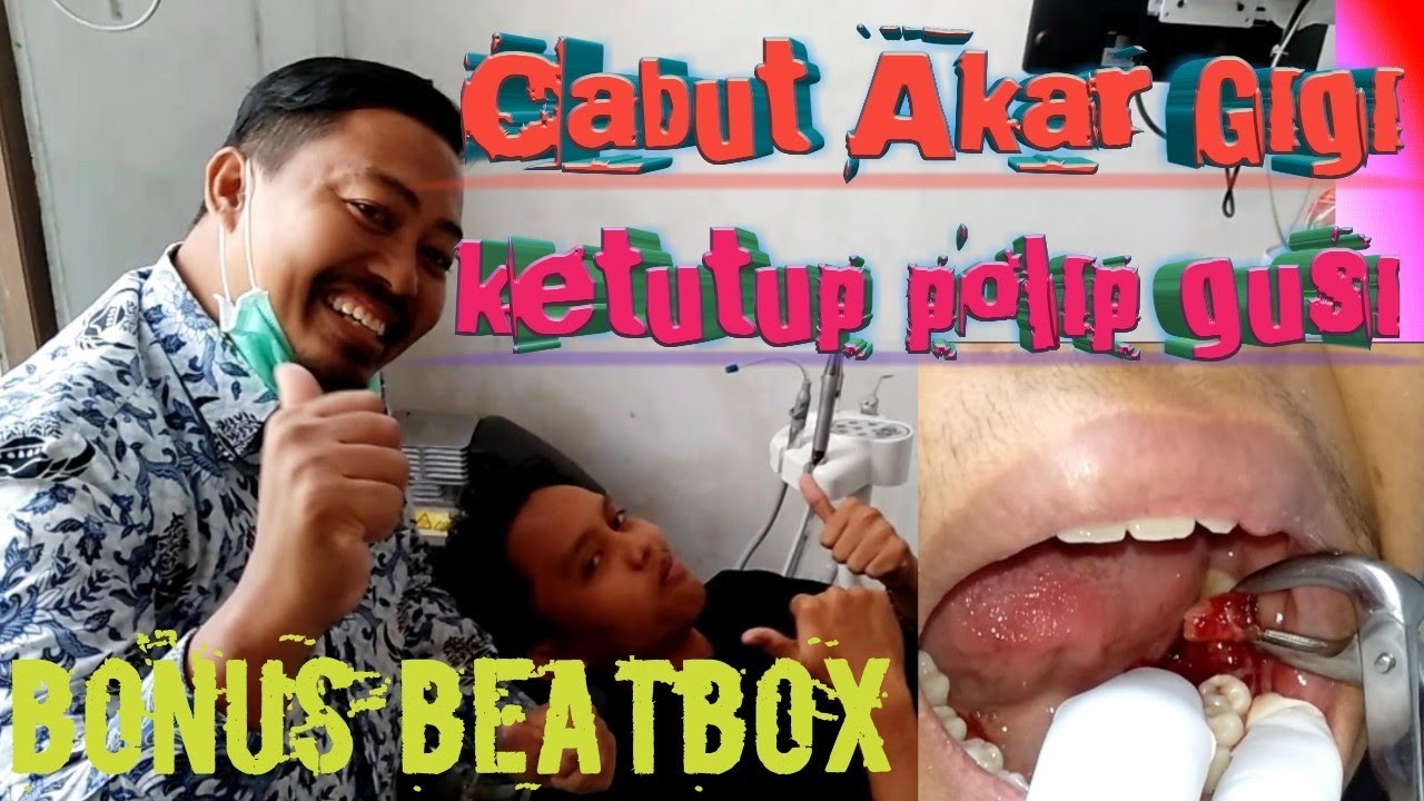 Pencabutan Sisa Akar Geraham Bawah Yang Ditumbuhi Polip Gusi - YouTube