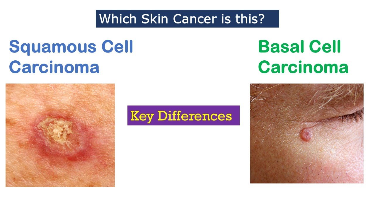 Skin Cancer! Squamous Cell Carcinoma vs Basal Cell Carcinoma | How to ...