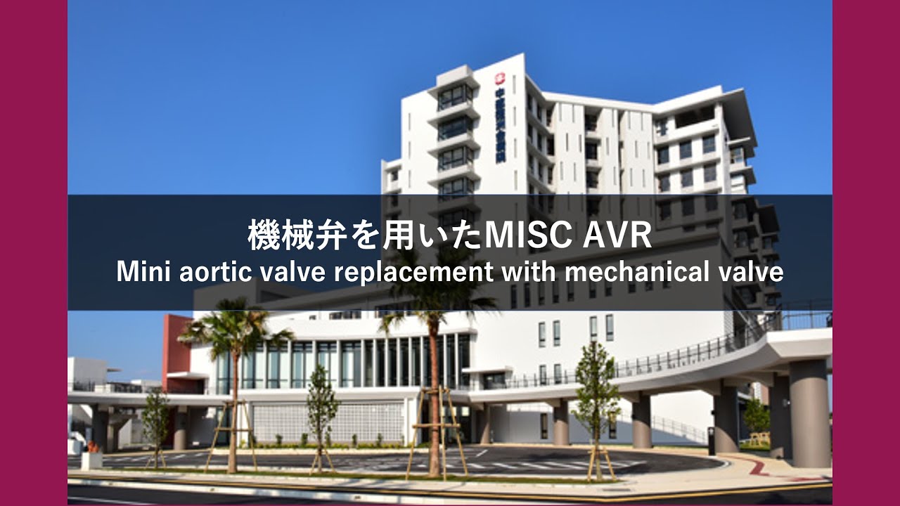 機械弁を用いたMICS AVR; Mini aortic valve replacement with mechanical valve ...