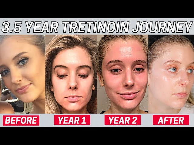 Tretinoin Before And After