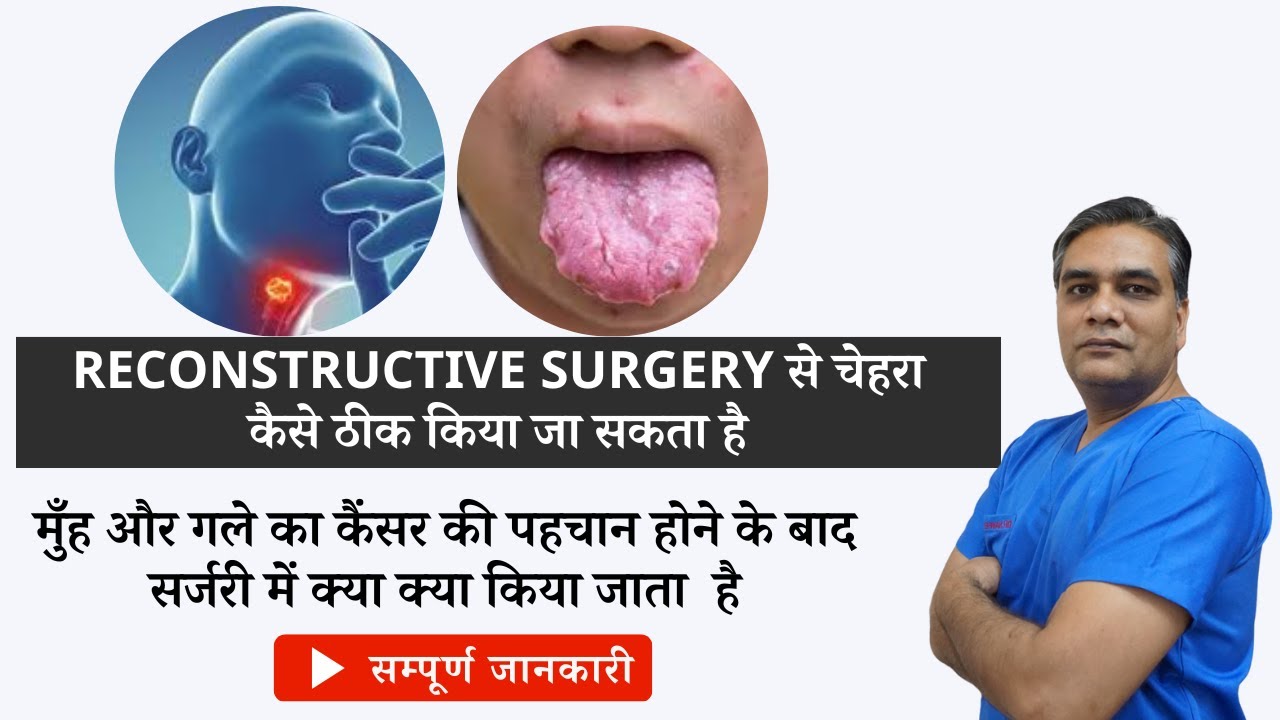 Muh Aur Gale Ke Cancer Ka Ilaj Kya Hai Oral Cancer के बाद