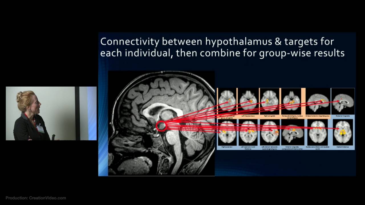 Hypothalamic Hamartoma Imaging Use In Diagnosis And Management By Varina Boerwinkle Youtube