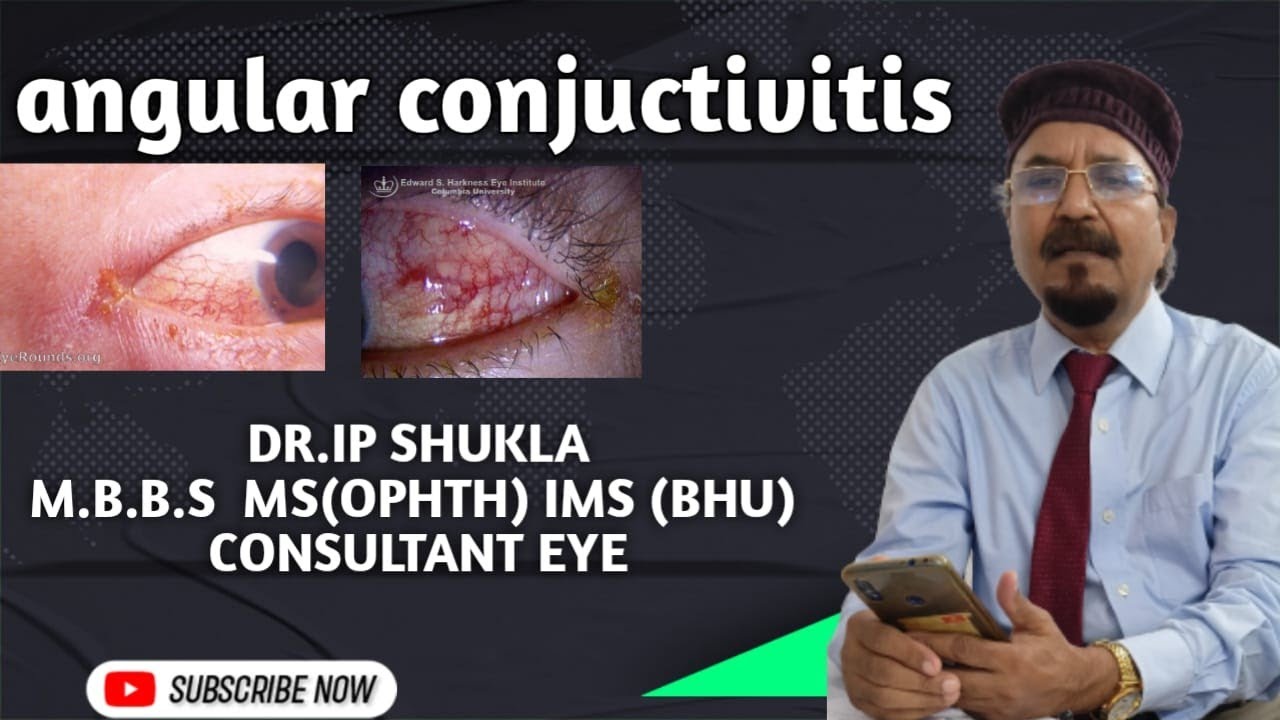 angular conjuctivitis || Dr. ip shukla - YouTube