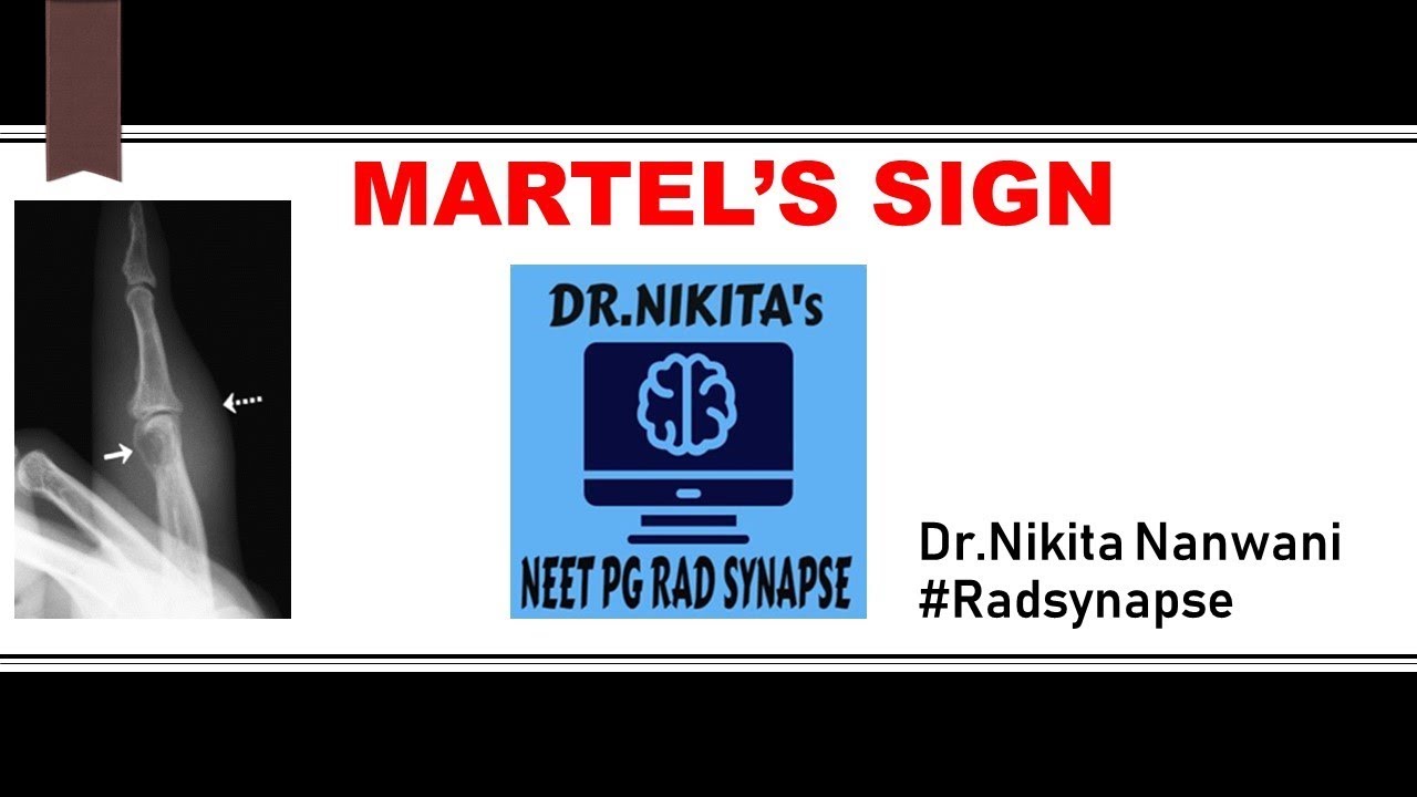 Martel's sign /G sign/ Rat bite erosions- GOUT - YouTube