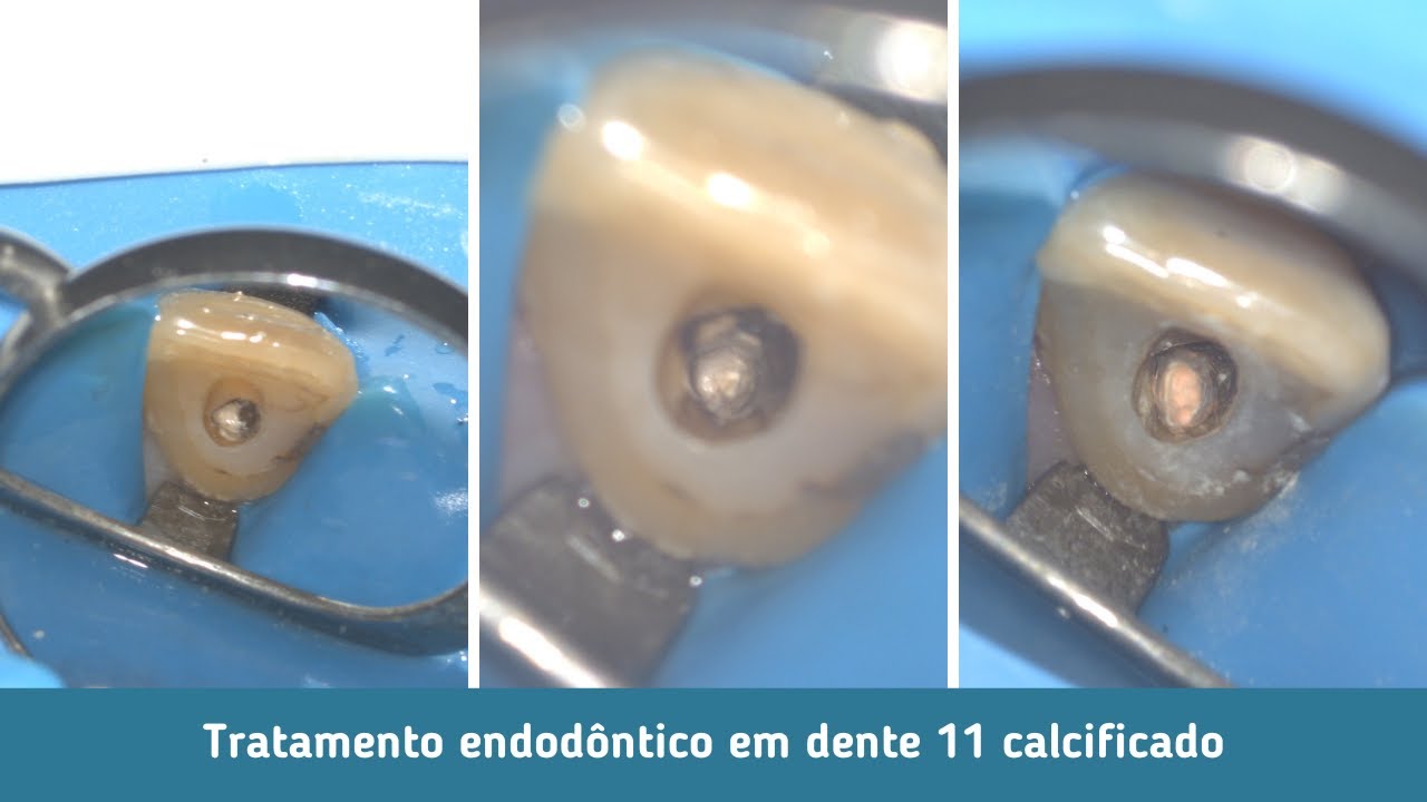 [Endodontia Microscópica Avançada] - Tratamento endodôntico de dente 11 ...