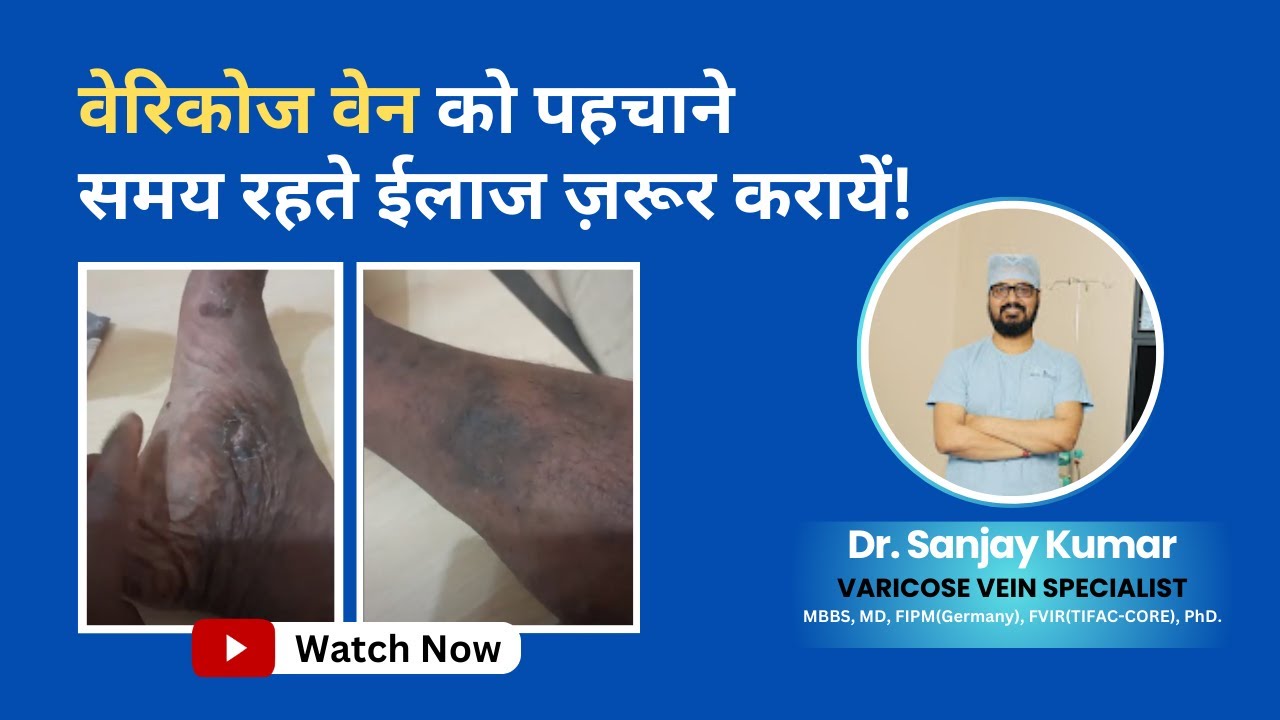 वेरिकोज वेन को पहचाने समय रहते ईलाज ज़रूर करायें Dr Sanjay Kumar