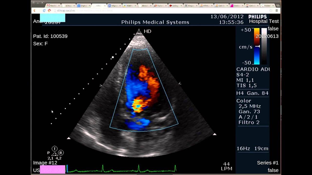 Viewing a cardiac ultrasound doppler (Dicom multiframe) on medview - YouTube