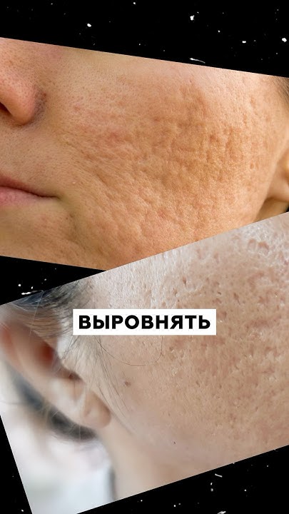 Как лечить рубцы после акне рубцы косметологиямосква постакне Youtube
