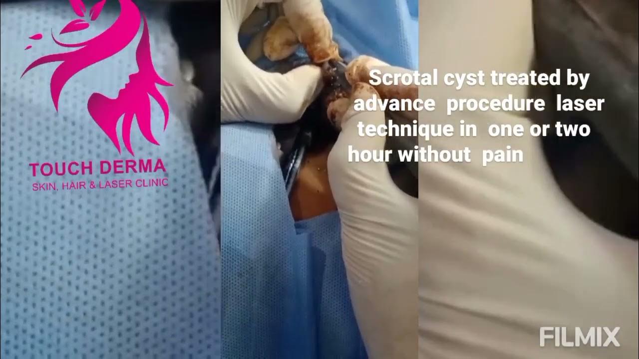 Scrotal Cyst Treated By Advance Procedure Laser At Touch Derma Clinic Us 8077843257 7840050530