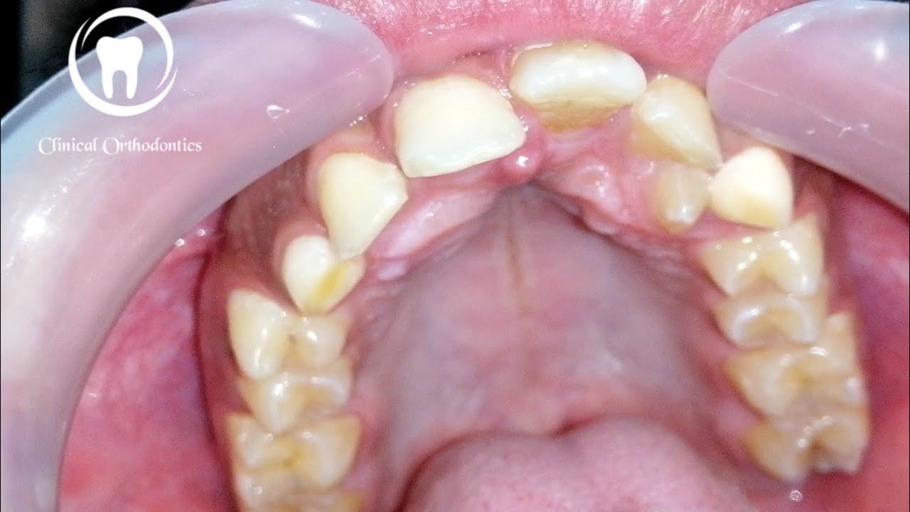 Alignment stage : retained ( C )s and impacted canine - YouTube