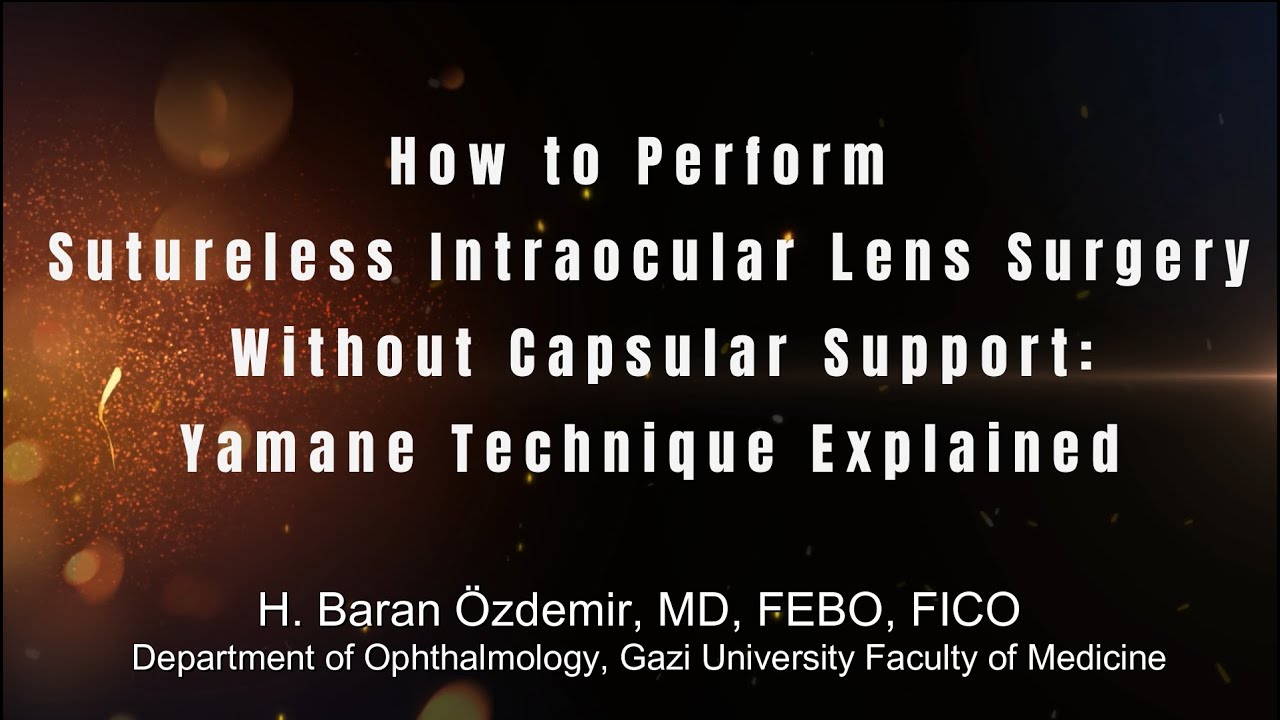 How to Perform Sutureless Intraocular Lens Surgery Without Capsular ...