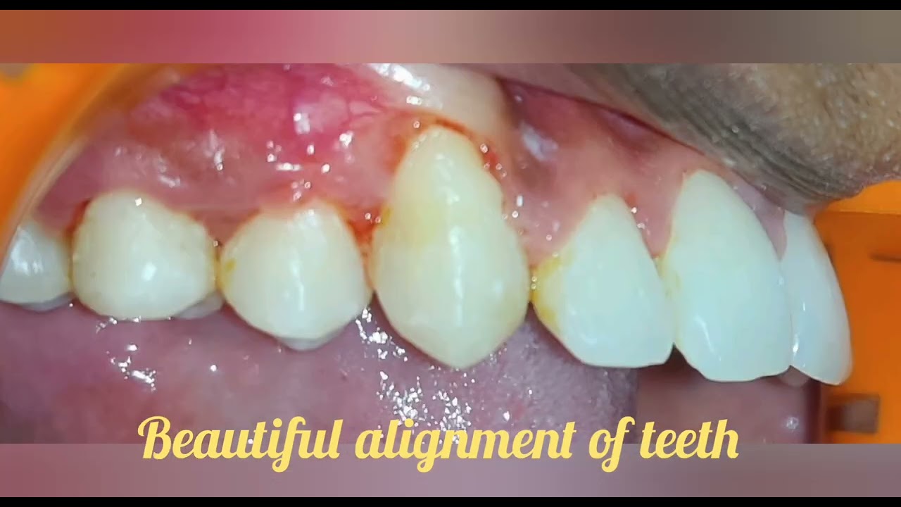 Correction of transposition of canine and premolar - YouTube