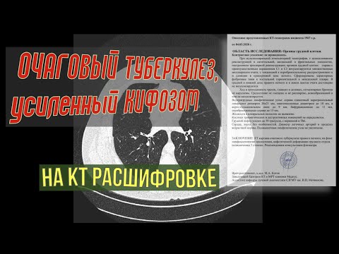 ОЧАГОВЫЙ ТУБЕРКУЛЕЗ легких осложненный КИФОЗОМ грудного отдела позвоночника на РАСШИФРОВКЕ КТ легких