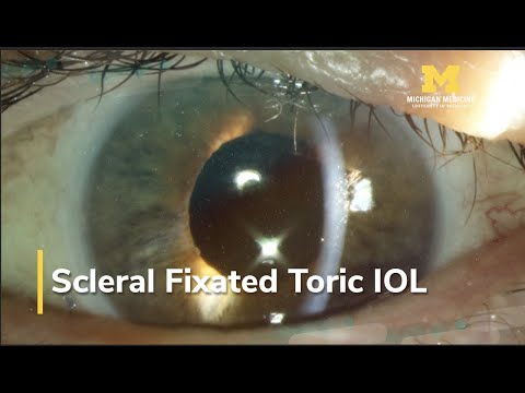 Scleral Fixated Toric IOL | Nallasamy - YouTube