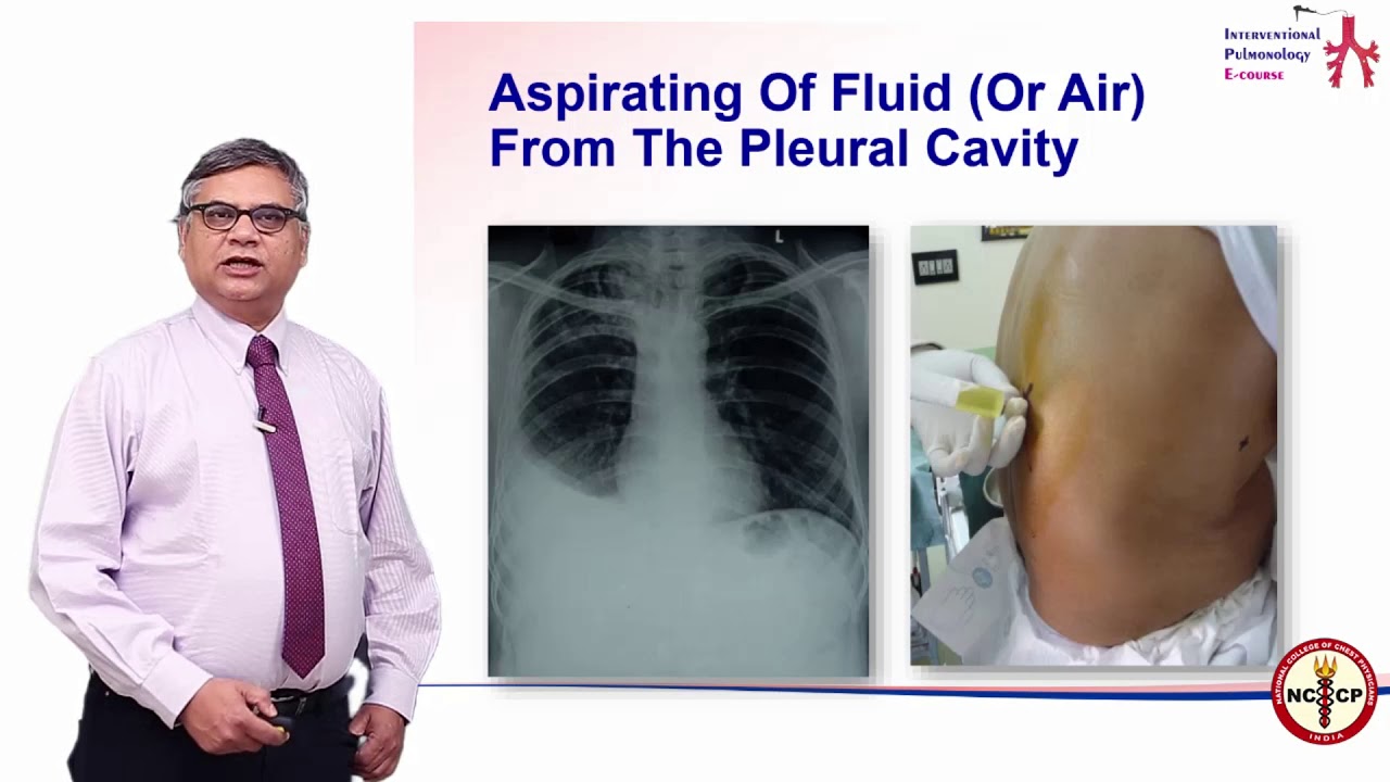 Pleurocentesis - Dr Dharmesh Patel - IPeC - YouTube