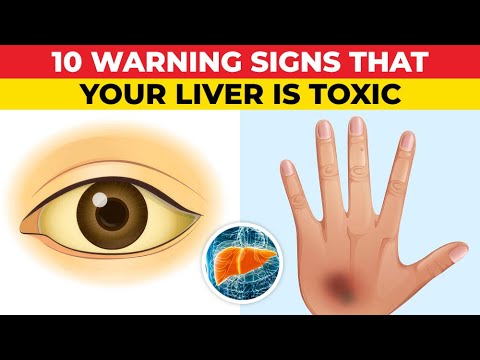 10 Warning Signs of a Toxic Liver - YouTube