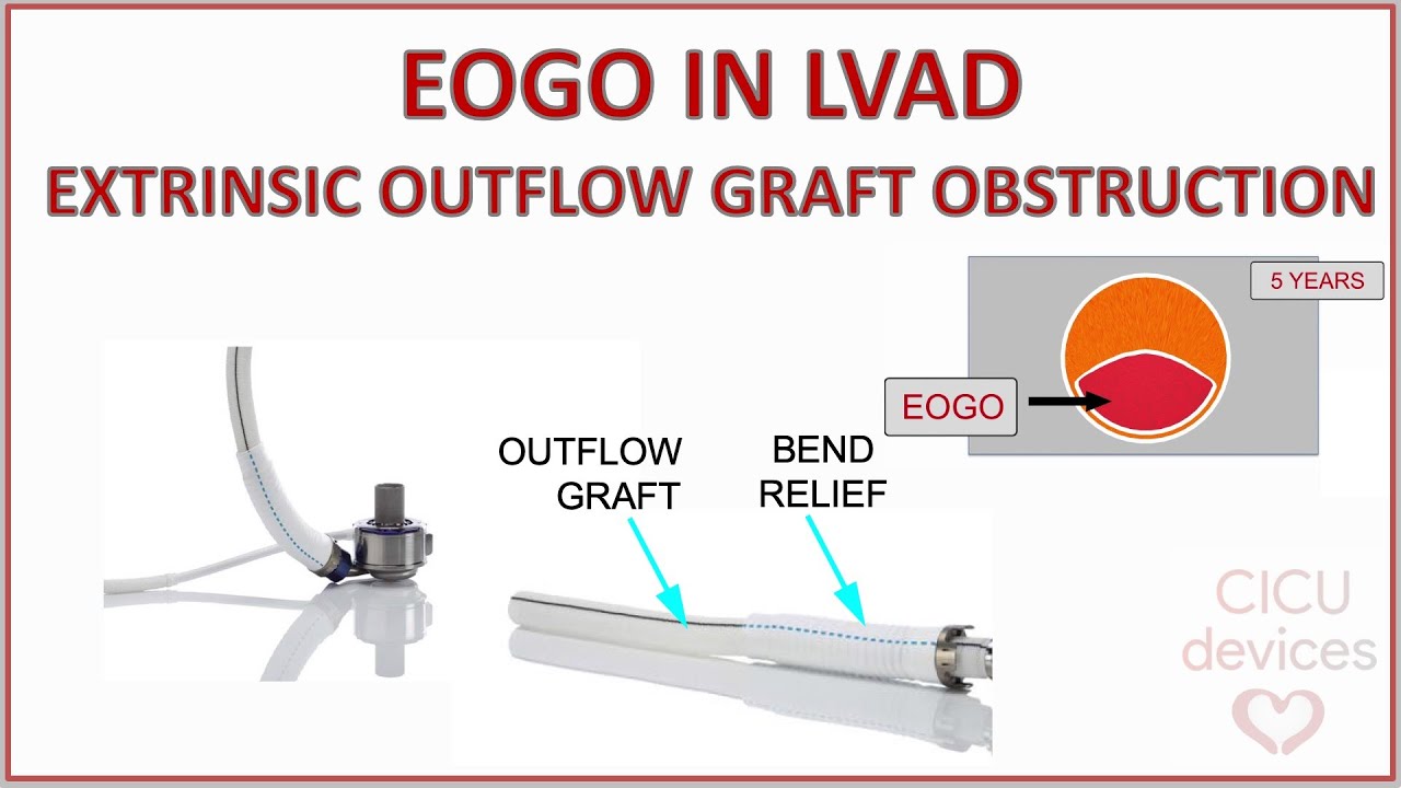 ⚙️ LVAD HEARTMATE EOGO - EXTRINSIC OUTFLOW GRAFT OBSTRUCTION - SAFETY ...