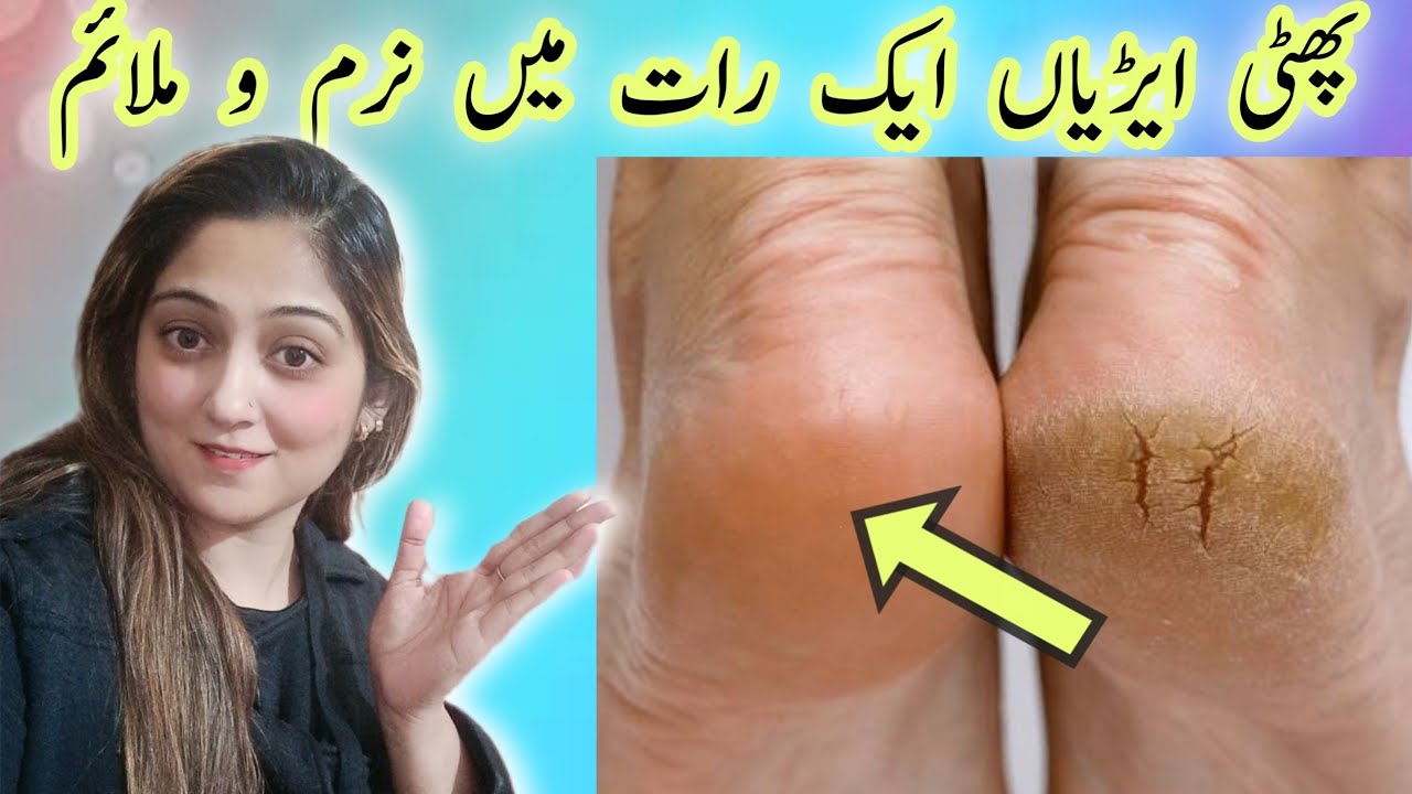 Get Rid of cracked Heels in 1 night l Removed cracked heels Remedy l ...