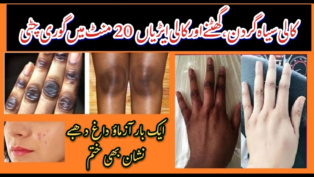 How To Whiten And Brighten Dark Knuckles, Elbows, Knees, Neck | Dark ...