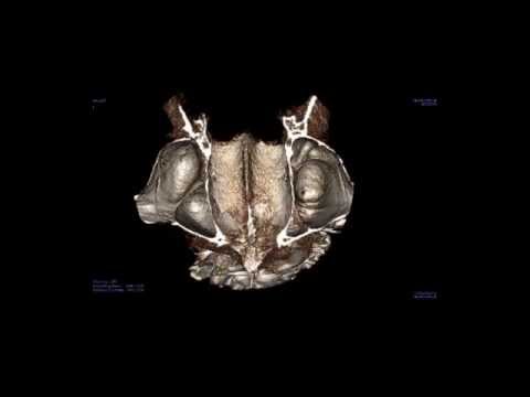 maxillary sinus 3D CT - YouTube