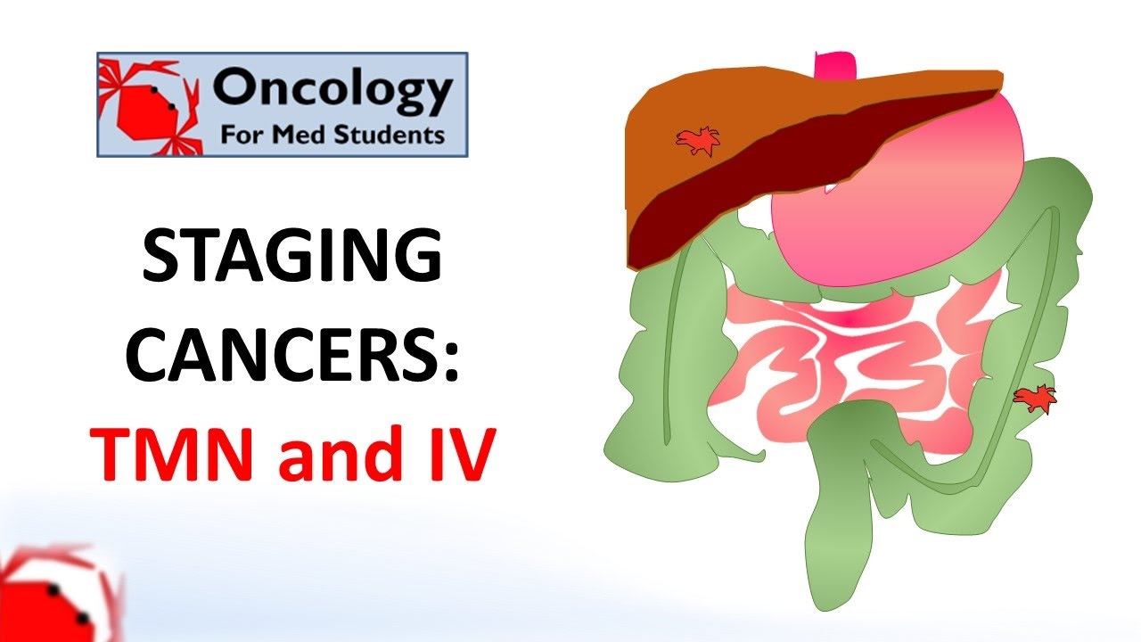 Staging cancers: TNM and I-IV systems - YouTube