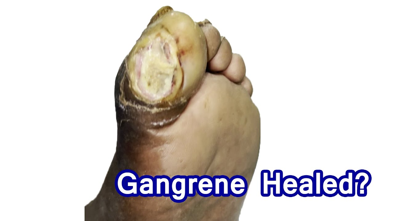 Gangrene Foot Amputation ? Before After Video #diabeticfoot # ...