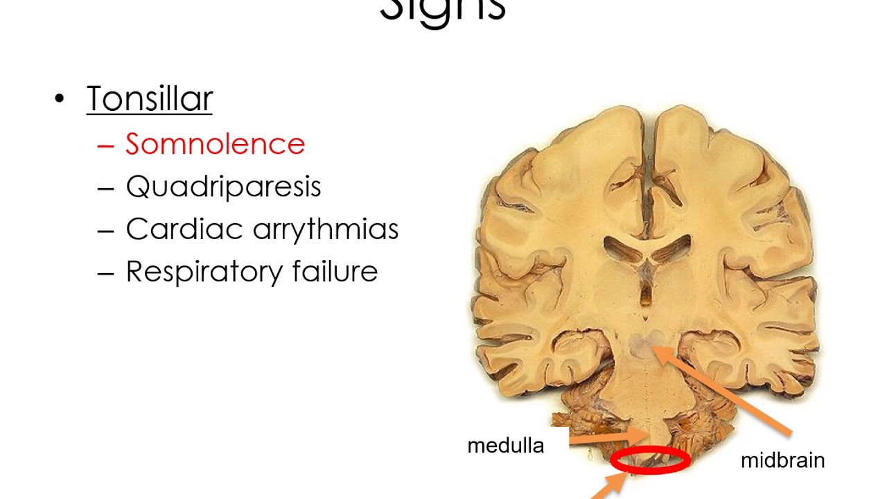 Approach to a child with Altered Sensorium by Dr Anand Shandilya - YouTube