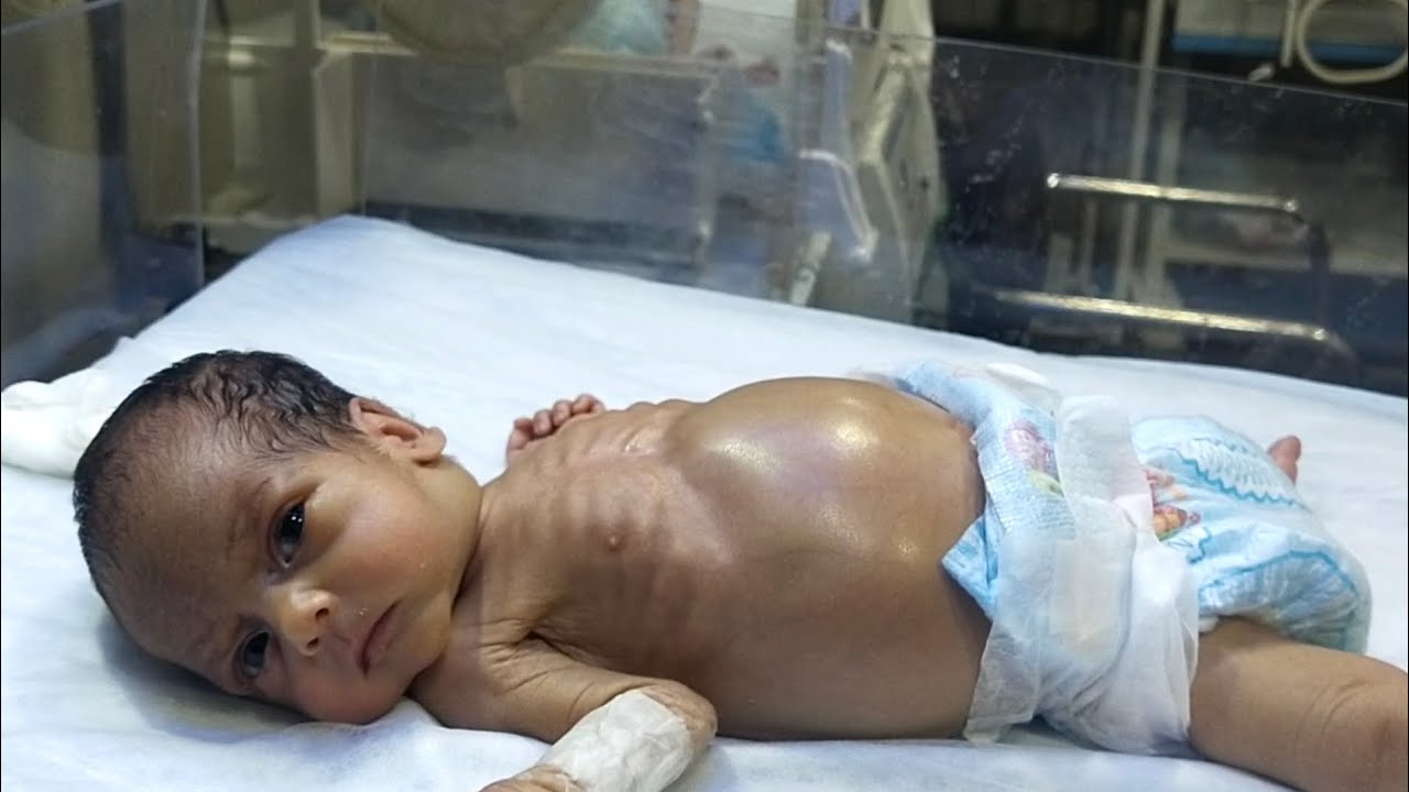 Premature Baby with Abdominal Distension and Colic Pain 🍼 | NICU Case ...