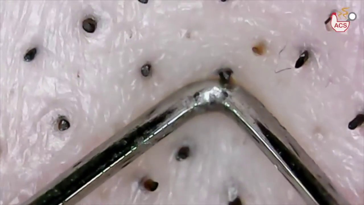 Cystic Acne Blackheads And Pimples Extraction 17 - YouTube