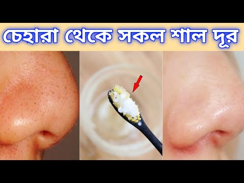 Blackheads এবং  Whiteheads গোঁড়া থেকে তুলে ফেলুন মাত্র ৩ মিনিটে/সকল কালো শাল দূর করার উপায়