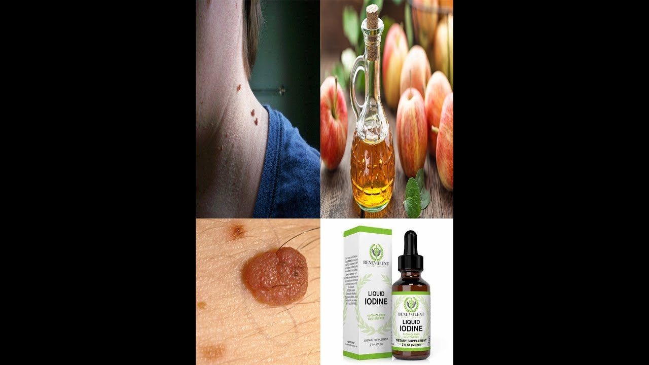 How to Get Rid of Skin Tags on Armpits - YouTube